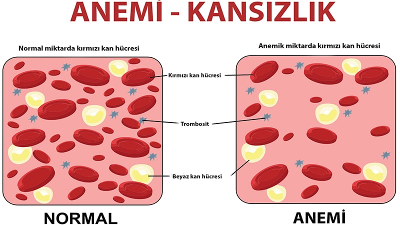 Anemi (Kansızlık) Nedir? (Anemi Belirtileri ve Tedavisi) - Ogreniyo.com